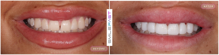 SmileFast | Affordable Smile Improvement | Riverdale Healthcare